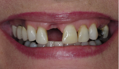 10 Dental Consequences of Not Replacing Missing Teeth | Joseph Pechter, DMD